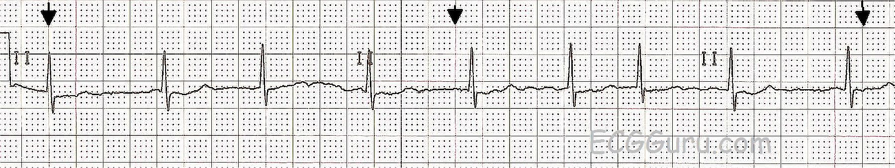 Ecg Basics Atrial Fibrillation With A Controlled Ventricular Response Ecg Guru Instructor